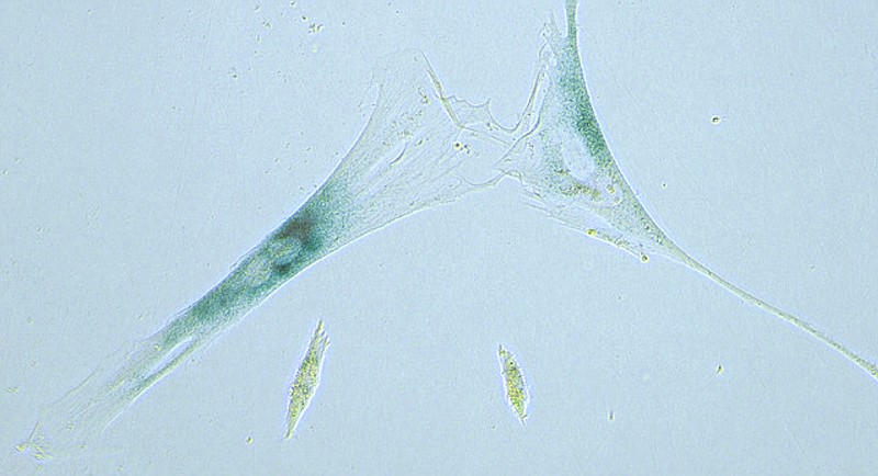 ‘Zombie cells’ buildup in your body may play role in aging | Jefferson ...