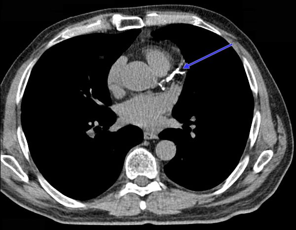 The Docs: What is coronary calcium scanning?