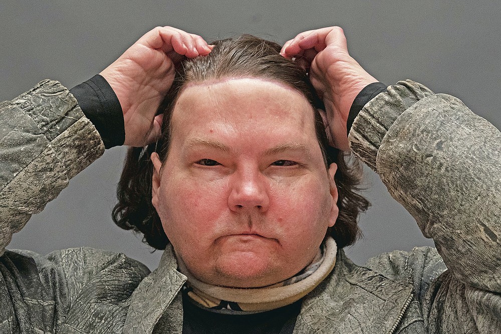 Man, 22, gets face, hands in rare surgery