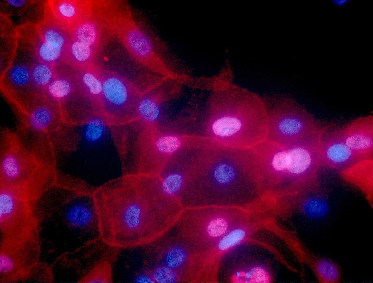 Some cancer patients can skip treatments, two studies show | Texarkana ...