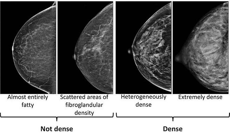 Dense breasts can make it harder to spot cancer on mammograms ... Dense breasts can make it harder to spot cancer on mammograms ...