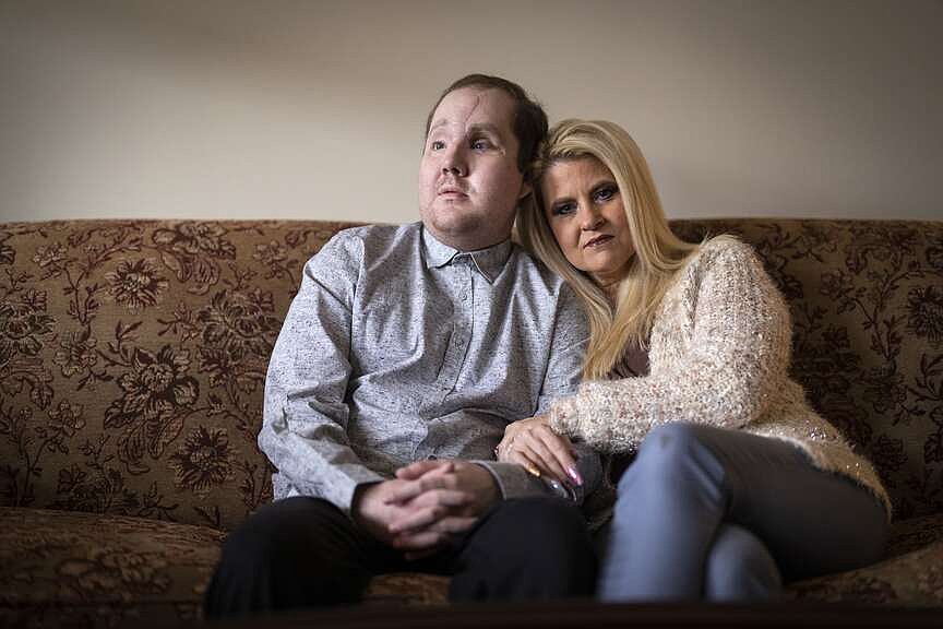 Transplant at Mayo Clinic replaces 85 percent of patient’s face after ...