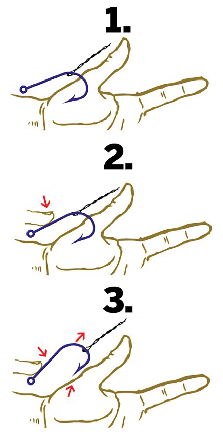 First aid tips for the common angler | Chattanooga Times Free Press