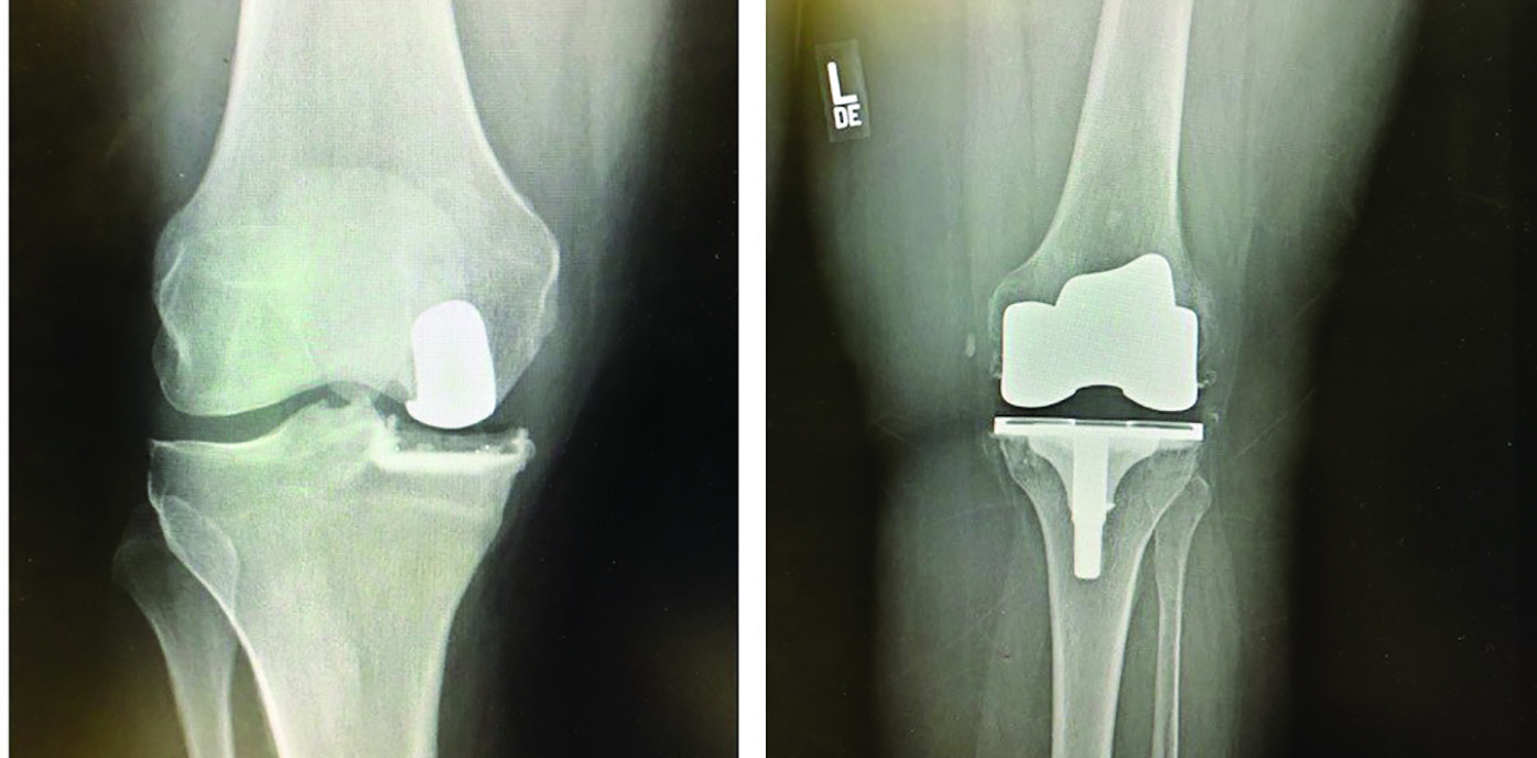 Chattanooga surgeon pioneers minimally invasive alternative to total ...