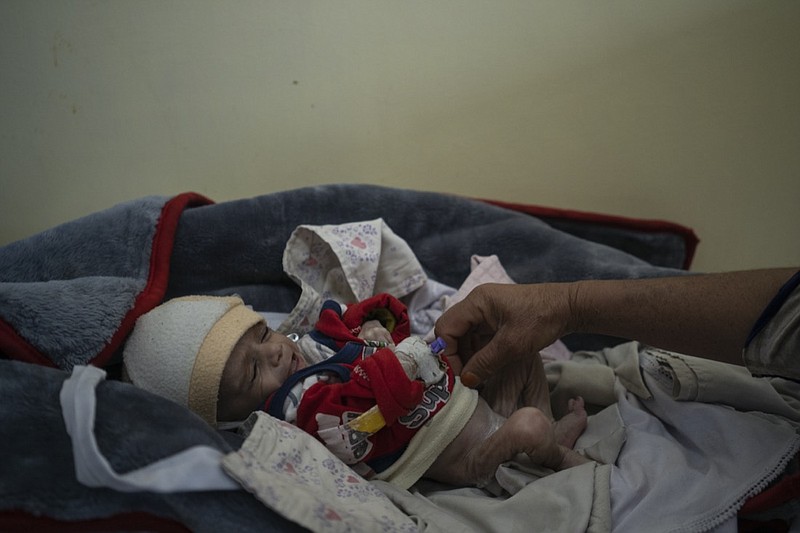 Emaciated children in Kabul hospital point to rising hunger ...